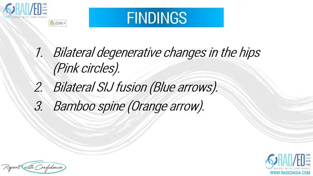 ANKYLOSING SPONDYLITIS PERIPHERAL JOINT HIP INVOLVEMENT X-RAY ...