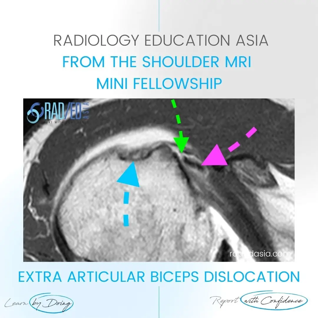 BICEPS DISLOCATION MRI SHOULDER RADIOLOGY - Radiology Education Asia