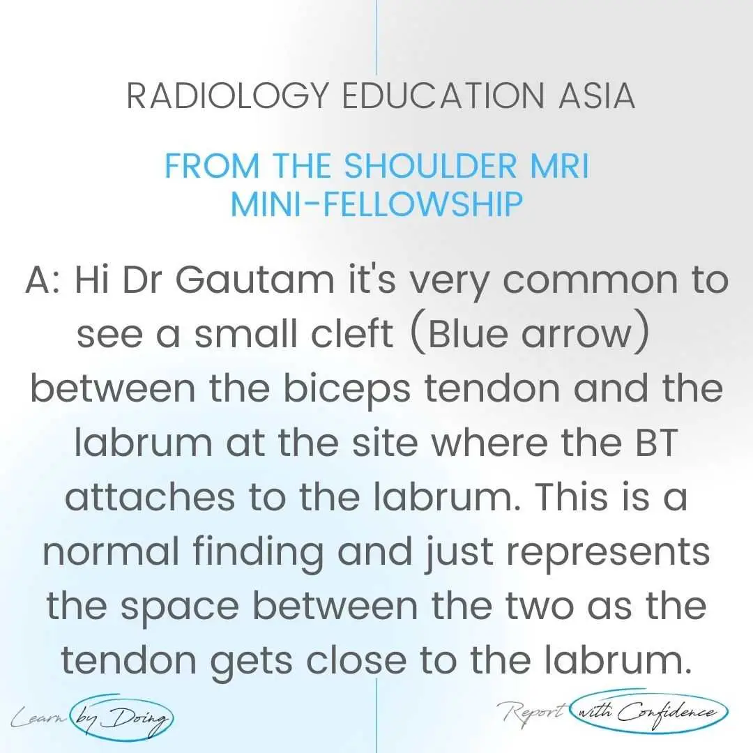 SHOULDER MRI BICEPS LABRUM JUNCTION: Q&A FROM THE COURSE - Radiology ...