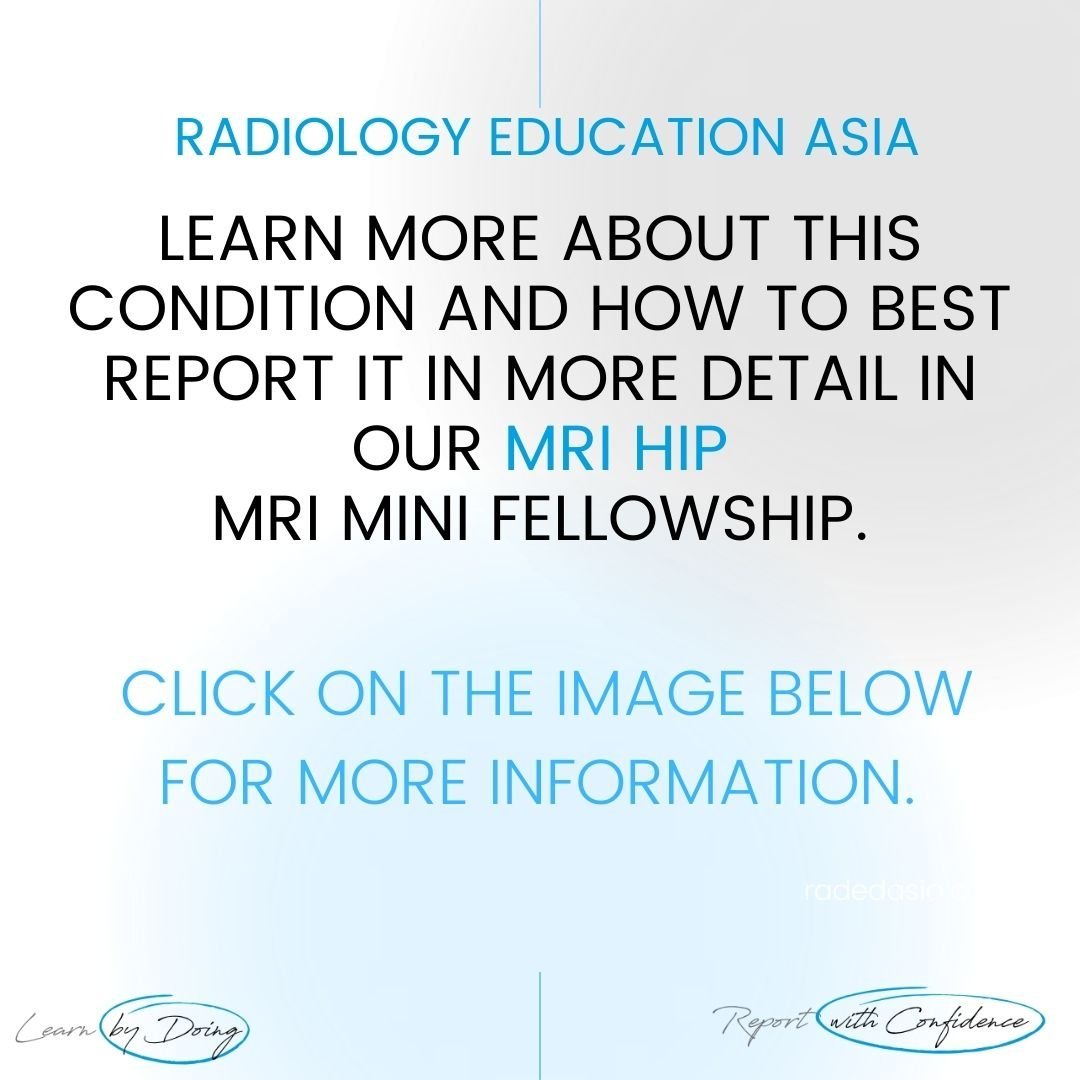 HIP LABRUM LABRAL TEAR MRI RADIOLOGY - Radiology Education Asia