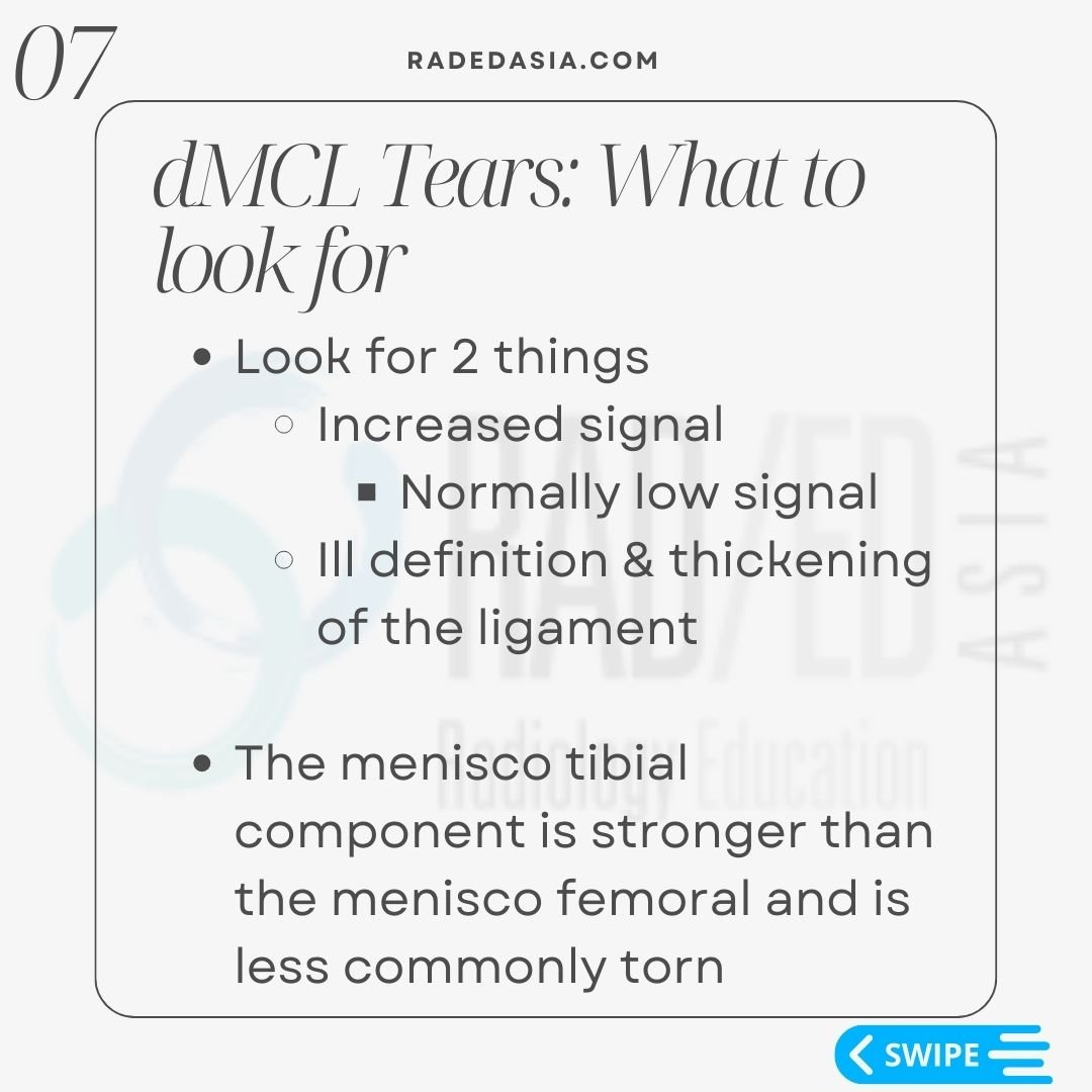 Meniscotibial Ligament Tear Deep Mcl Mri Knee Radiology Education Asia