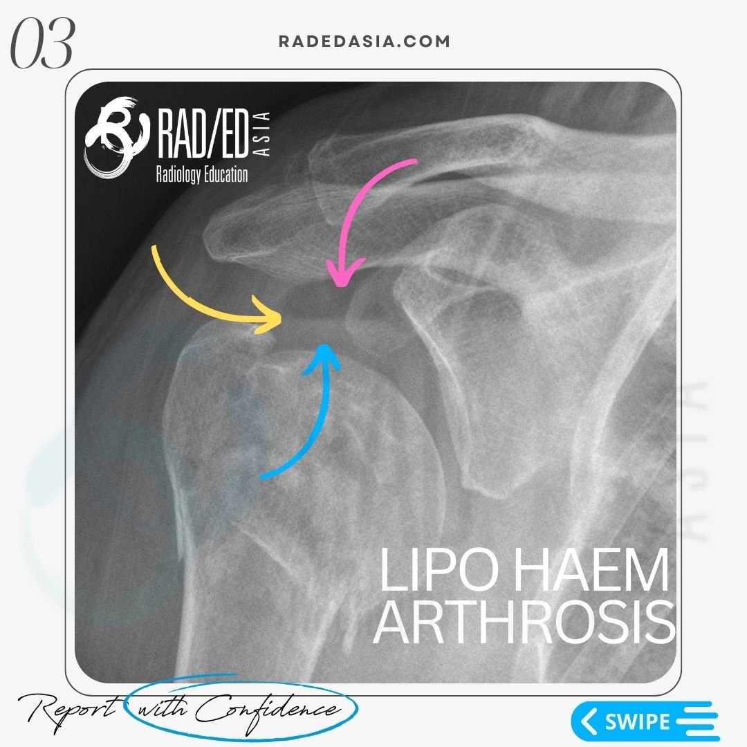 LIPOHEMARTHROSIS RADIOLOGY SHOULDER XRAY - Radiology Education Asia