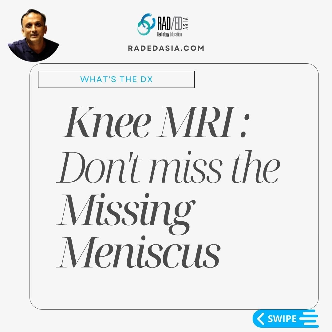 MENISCUS TEAR MRI KNEE: MISSING MENISCI WHAT TO LOOK FOR - Radiology ...
