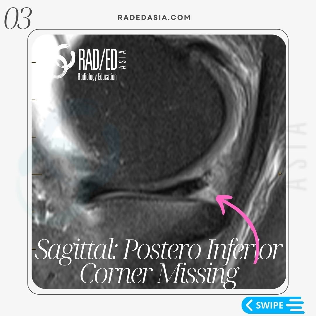 MENISCUS TEAR MRI KNEE: MISSING MENISCI WHAT TO LOOK FOR - Radiology ...