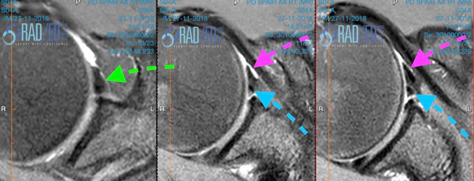 MRI MGHL SHOULDER LIGAMENT MIDDLE GLENO HUMERAL - Radiology Education Asia
