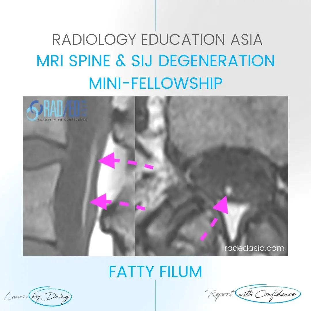 MRI FILUM TERMINALE SPINE: WHAT IS THE DX - Radiology Education Asia