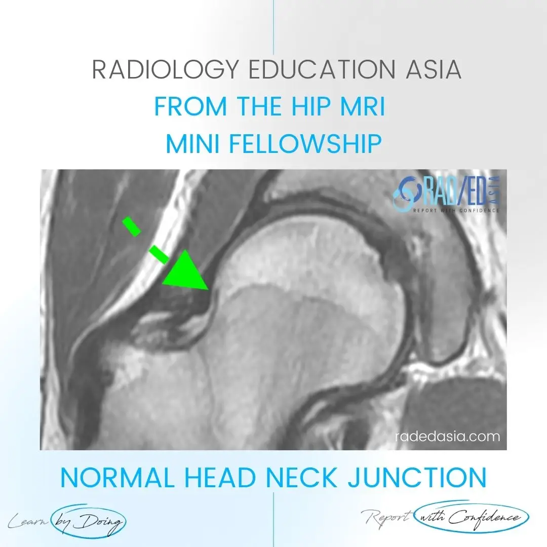 MRI HIP CAM FAI FEMORO ACETABULAR IMPINGEMENT - Radiology Education Asia