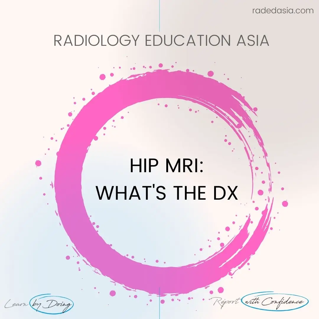 MRI HAMSTRING CONJOINT TENDON PARTIAL TEAR - Radiology Education Asia