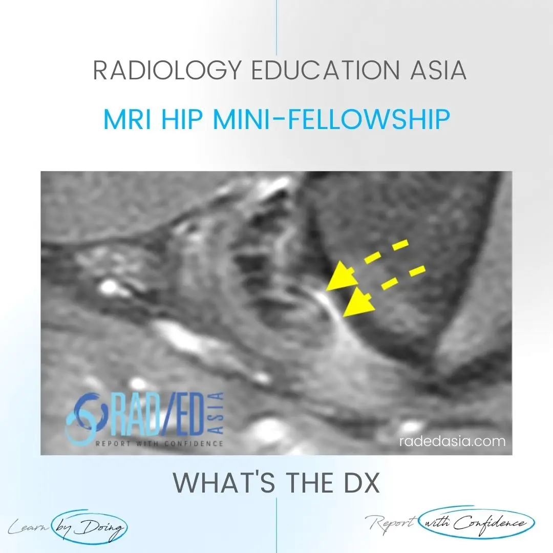 MRI HAMSTRING CONJOINT TENDON PARTIAL TEAR - Radiology Education Asia
