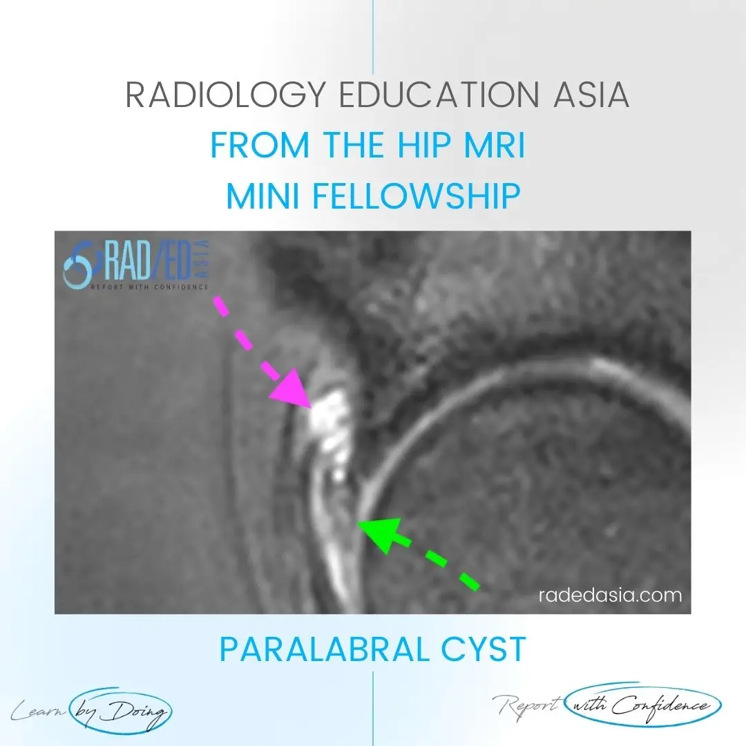 HIP PARALABRAL CYST MRI LABRUM TEAR DEGENERATION - Radiology Education Asia