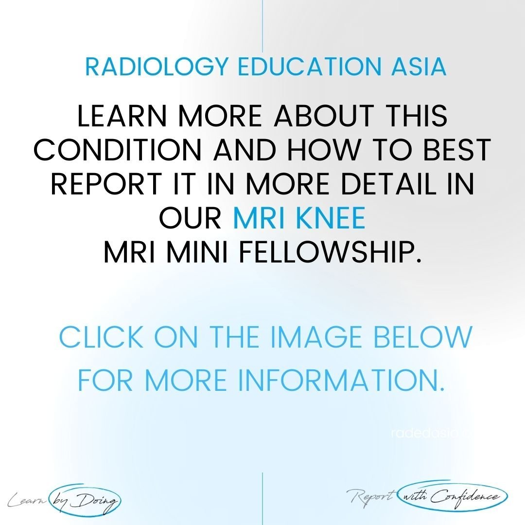 KNEE MRI PATELLA DISLOCATION SUBLUXATION - Radiology Education Asia