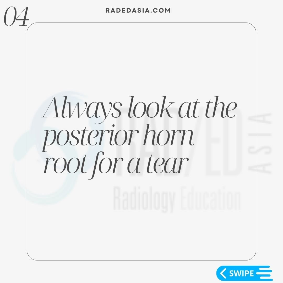 KNEE MRI MENISCUS ROOT TEAR EXTRUSION - Radiology Education Asia