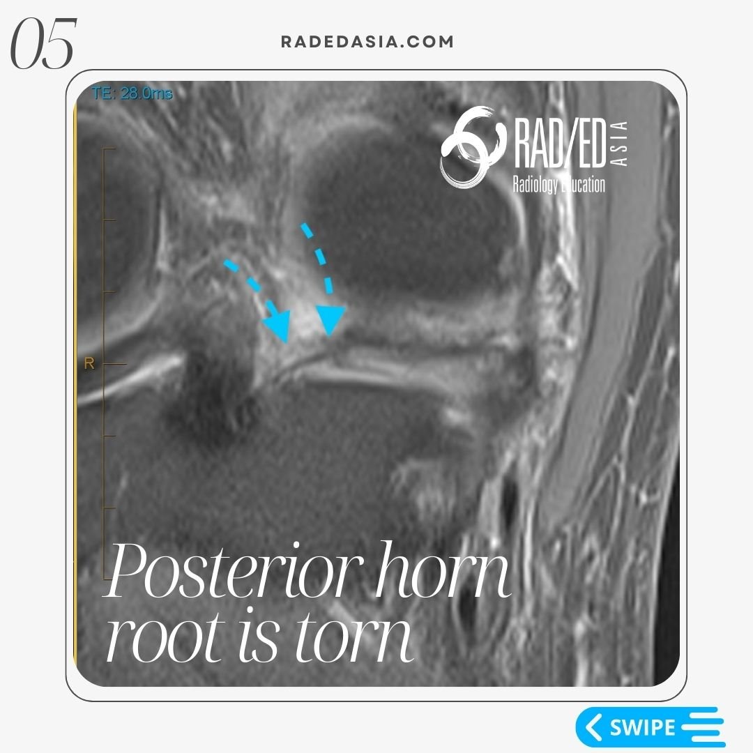 KNEE MRI MENISCUS ROOT TEAR EXTRUSION - Radiology Education Asia