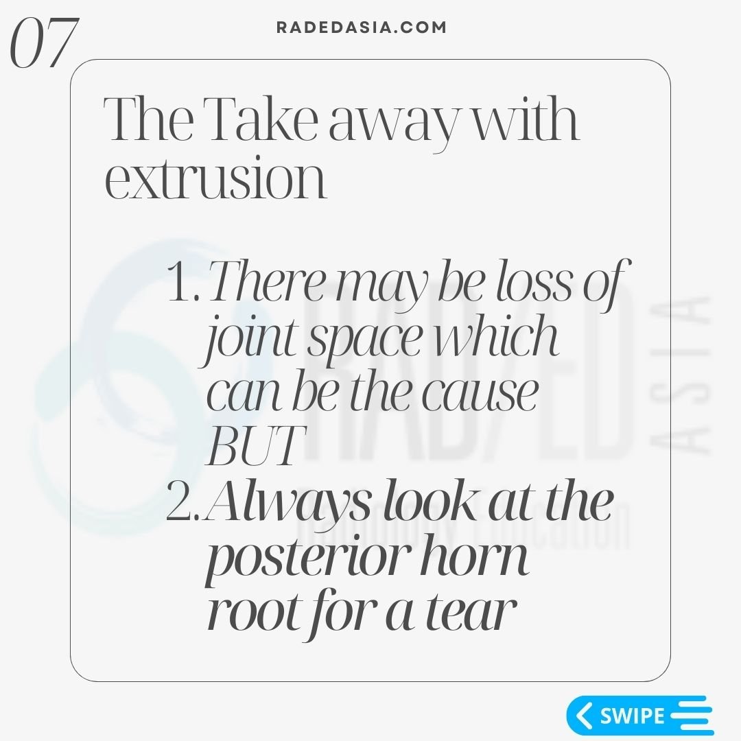 KNEE MRI MENISCUS ROOT TEAR EXTRUSION - Radiology Education Asia