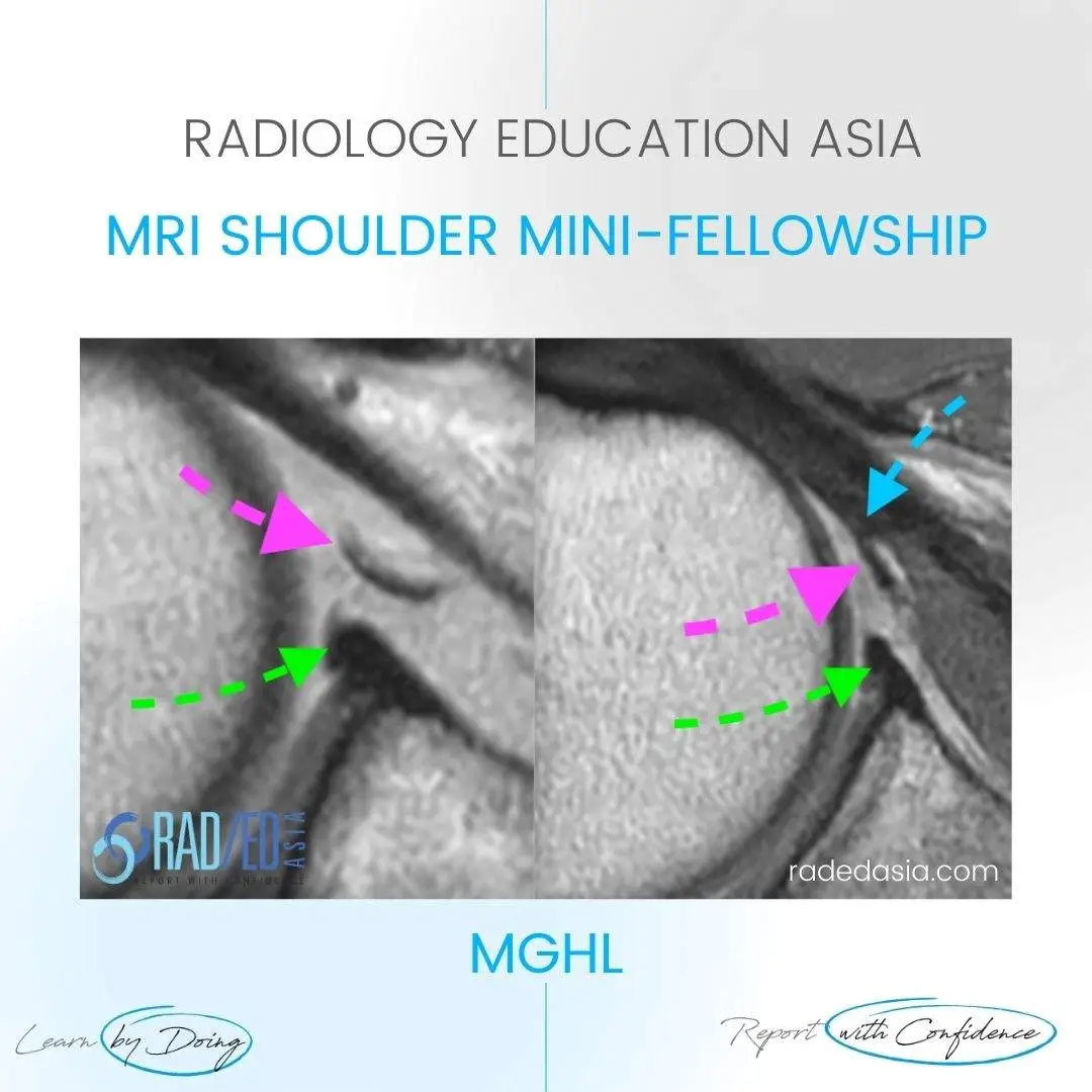 SHOULDER MRI MIDDLE GLENO HUMERAL LIGAMENT - Radiology Education Asia