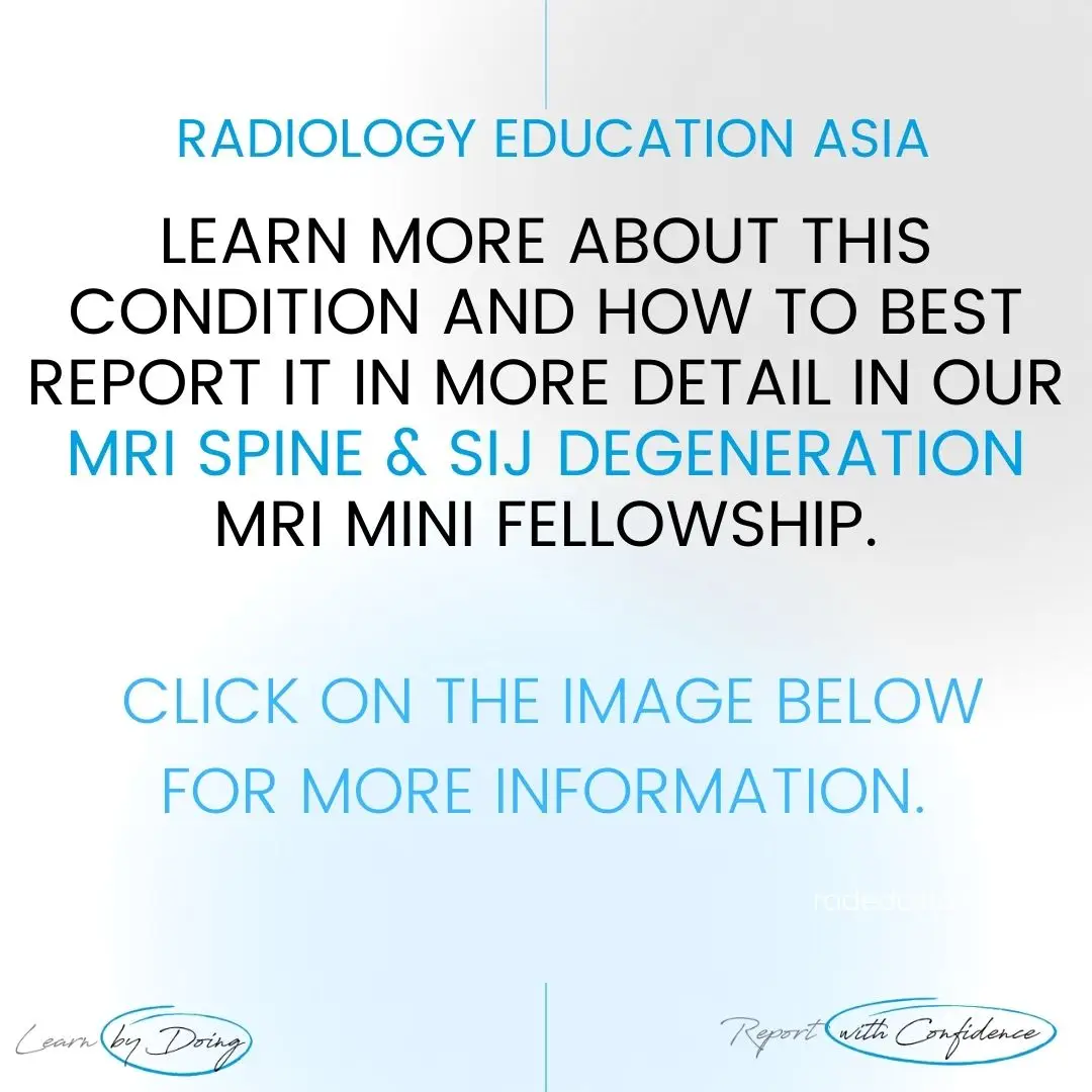 PARS DEFECT RADIOLOGY MRI - Radiology Education Asia