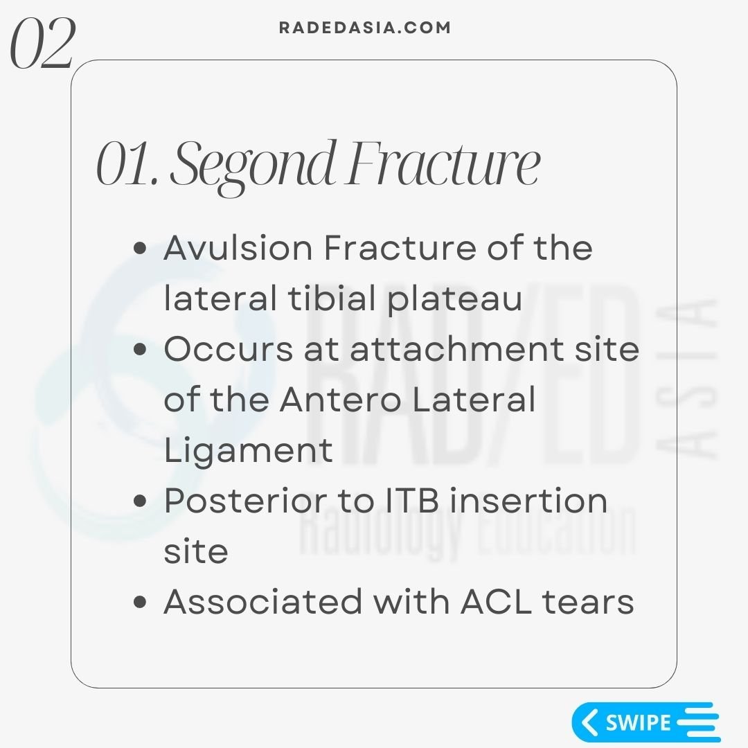 3 LATERAL KNEE FRACTURES SEGOND ARCUATE AND LATERAL FIBULAR FRACTURES ...