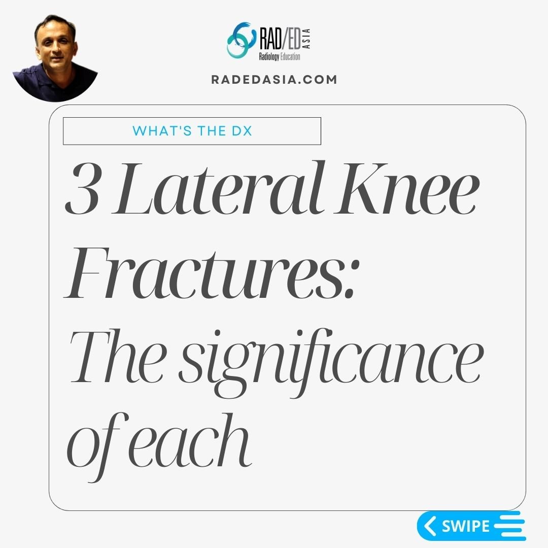 3 LATERAL KNEE FRACTURES SEGOND ARCUATE AND LATERAL FIBULAR FRACTURES ...