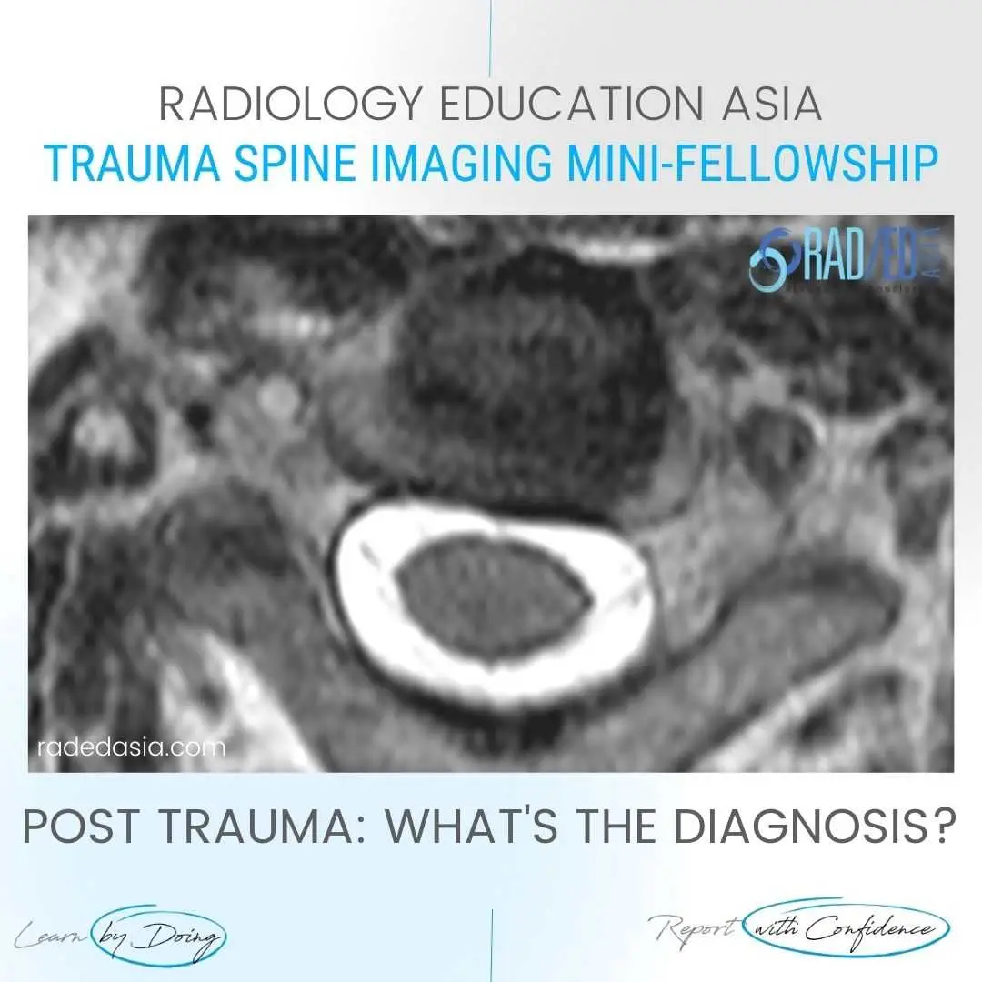 VERTEBRAL ARTERY DISSECTION RADIOLOGY MRI DIAGNOSIS - Radiology ...