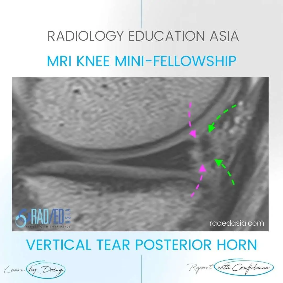 VERTICAL MENISCUS MENISCAL TEAR MRI KNEE - Radiology Education Asia