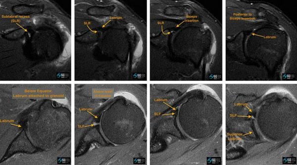 GLENOID LABRUM MRI SIMPLIFIED 4: Sublabral Foramen and Recess - Radedasia