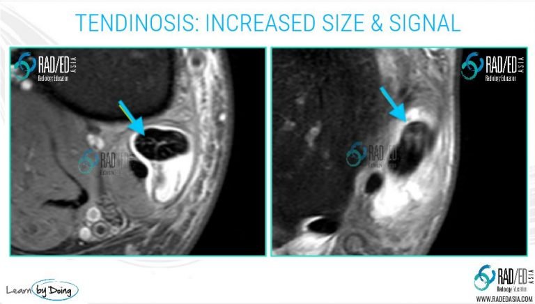 MRI TENDONS: AN EASY PATTERN TO ASSESS - Radedasia