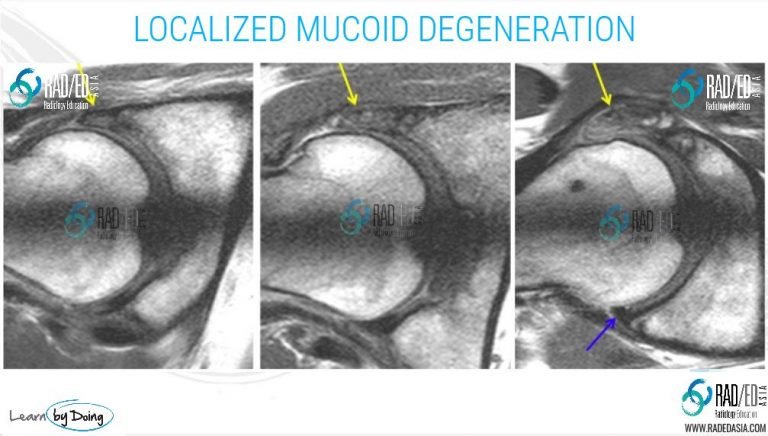 Hip Acetabular Labrum MRI More than just tears: Mucoid Degeneration ...