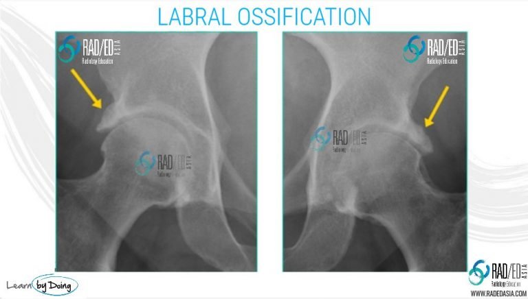 HIP LABRUM OSSIFICATION MRI: LABRAL ABNORMALITIES MORE THAN JUST TEARS ...