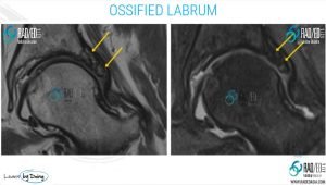 HIP LABRUM OSSIFICATION MRI: LABRAL ABNORMALITIES MORE THAN JUST TEARS ...