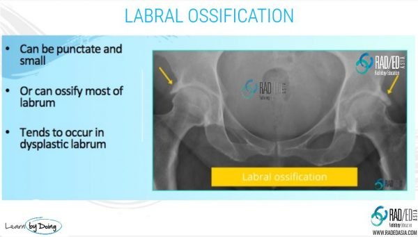 HIP LABRUM OSSIFICATION MRI: LABRAL ABNORMALITIES MORE THAN JUST TEARS ...