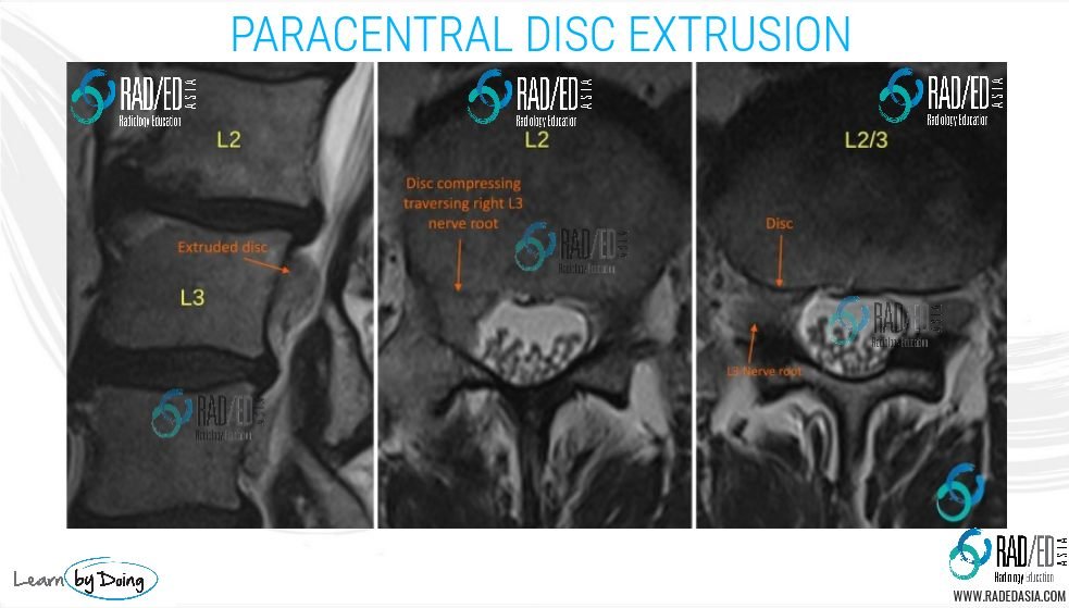 MRI LUMBAR: DISC HERNIATION & ACUTE DENERVATION - Radedasia