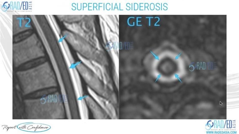 SUPERFICIAL SIDEROSIS MRI CORD AND SPINE (UPDATED 2021) - Radedasia