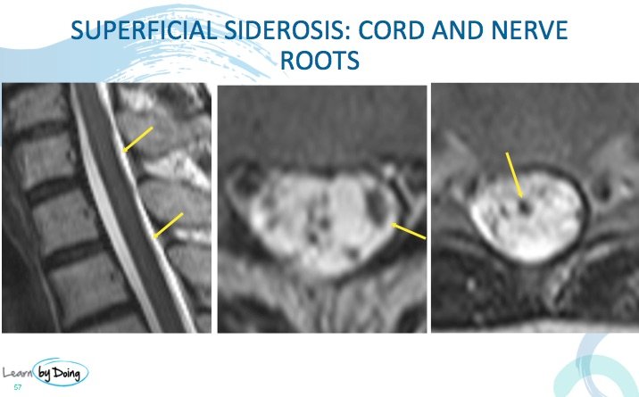 Superficial Siderosis of the Spine: What to look for - Radedasia