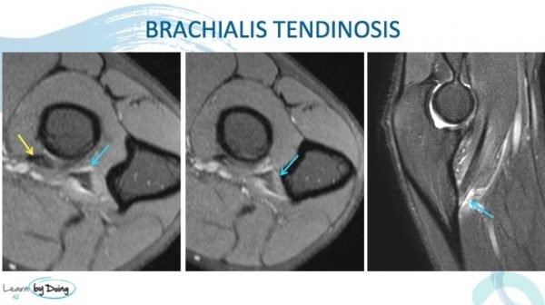 MRI ELBOW: BRACHIALIS TENDON INSERTION - Radedasia