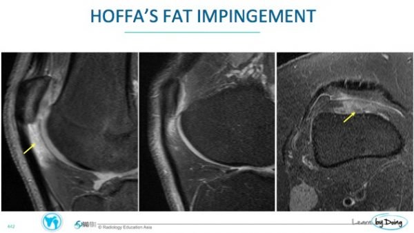 MRI KNEE: FAT PAD IMPINGEMENT - Radedasia
