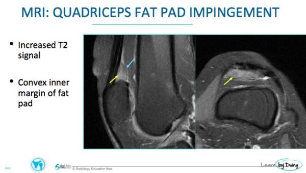 MRI KNEE: FAT PAD IMPINGEMENT - Radedasia