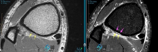 FROM PERIOSTITIS TO HEALING: THE RANGE OF TRAUMATIC PERIOSTEAL CHANGES ...