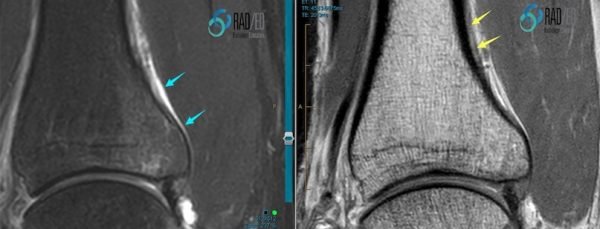 FROM PERIOSTITIS TO HEALING: THE RANGE OF TRAUMATIC PERIOSTEAL CHANGES ...