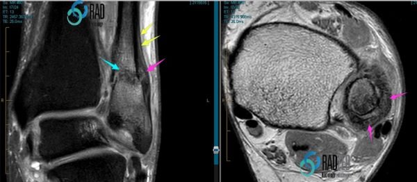 FROM PERIOSTITIS TO HEALING: THE RANGE OF TRAUMATIC PERIOSTEAL CHANGES ...