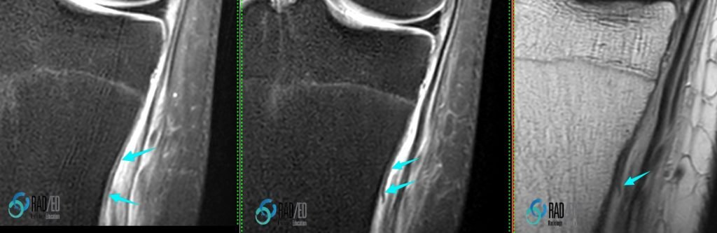 FROM PERIOSTITIS TO HEALING: THE RANGE OF TRAUMATIC PERIOSTEAL CHANGES ...
