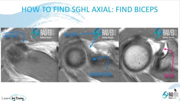 Glenohumeral Ligaments MRI Anatomy: Superior Gleno Humeral Ligament ...