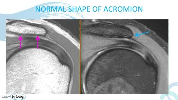 THREE TYPES OF ACROMIAL SPURS ON MRI: WHERE TO LOOK AND WHAT TO LOOK ...