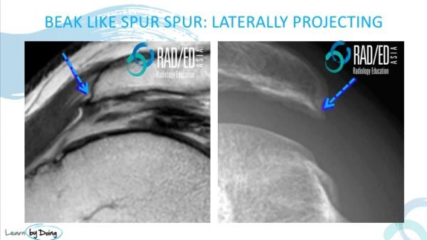 THREE TYPES OF ACROMIAL SPURS ON MRI: WHERE TO LOOK AND WHAT TO LOOK ...