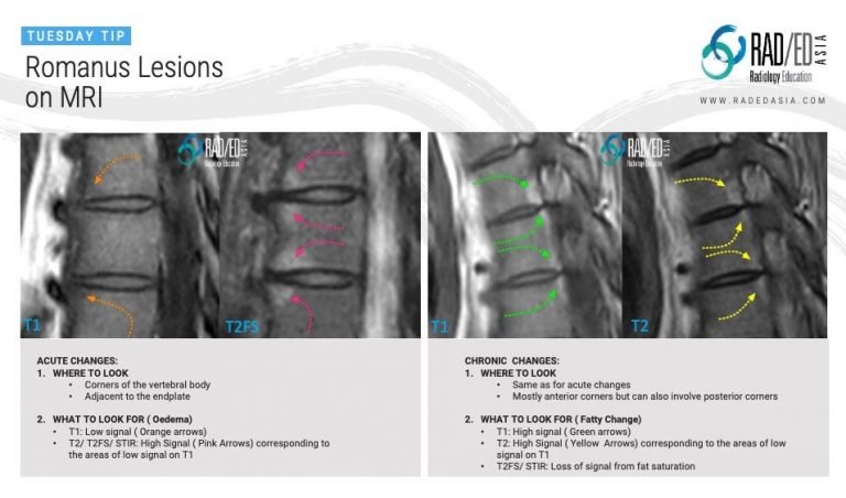 Tuesday Tip: Romanus Lesions 3: MRI Findings - Radedasia