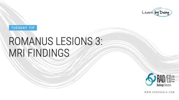 Tuesday Tip: Romanus Lesions 3: MRI Findings - Radedasia