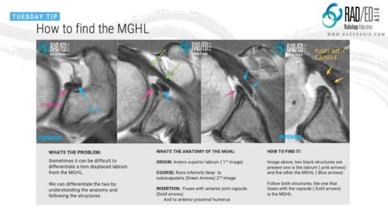 MRI SHOULDER: HOW TO FIND MGHL - Radedasia