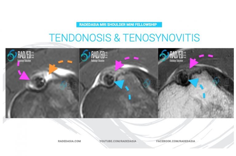 MRI BICEPS TENDON : TENDONOSIS AND TENOSYNOVITIS - Radedasia