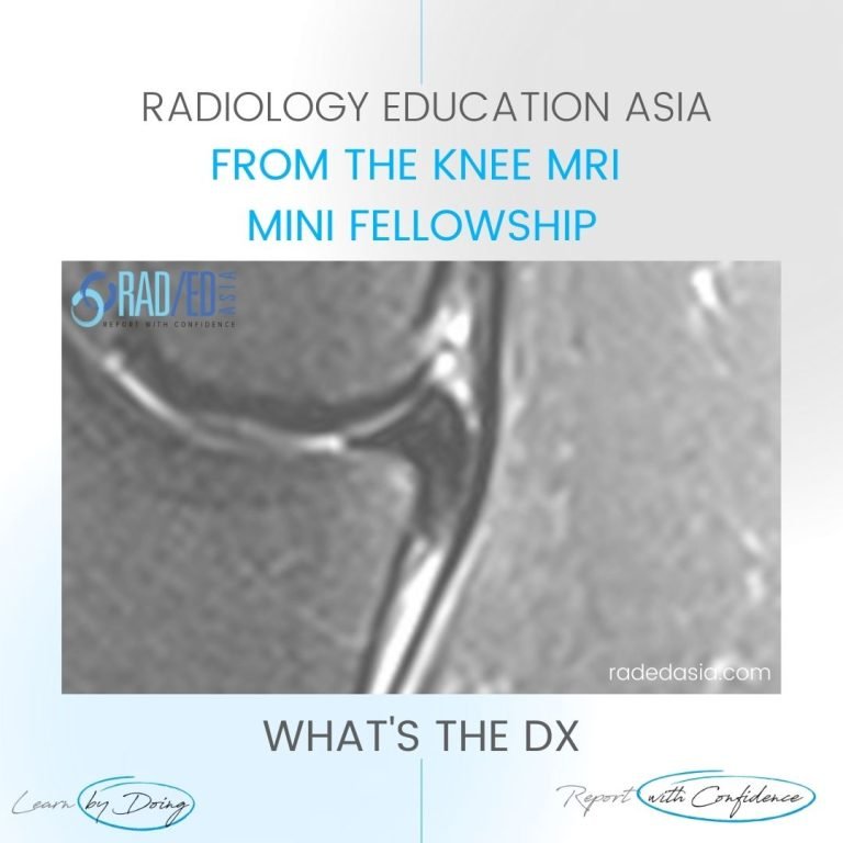 MENISCUS FLAP TEAR MRI KNEE - Radiology Education Asia