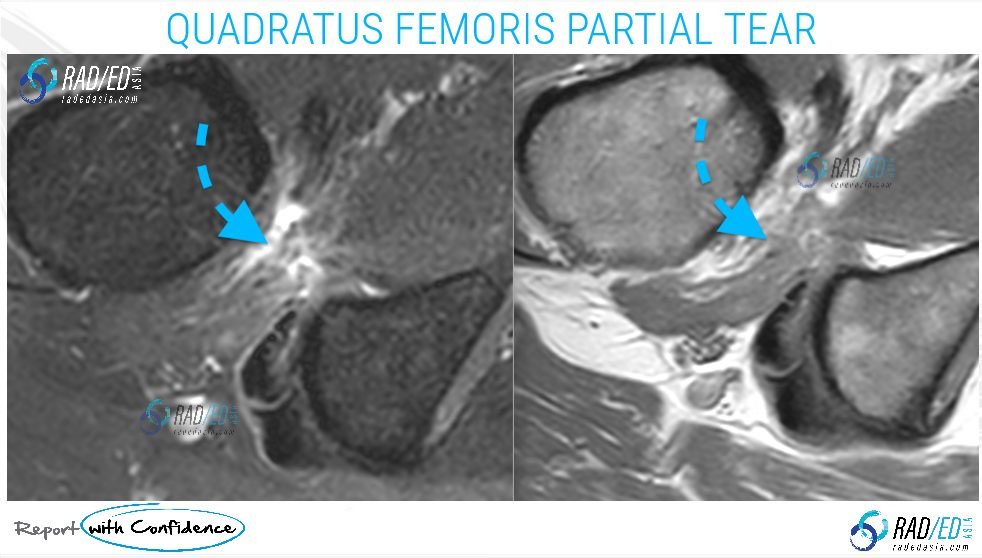 ISCHIOFEMORAL IMPINGEMENT MRI A PAIN IN THE BUTT Radedasia ISCHIOFEMORAL IMPINGEMENT MRI A PAIN IN THE BUTT Radedasia