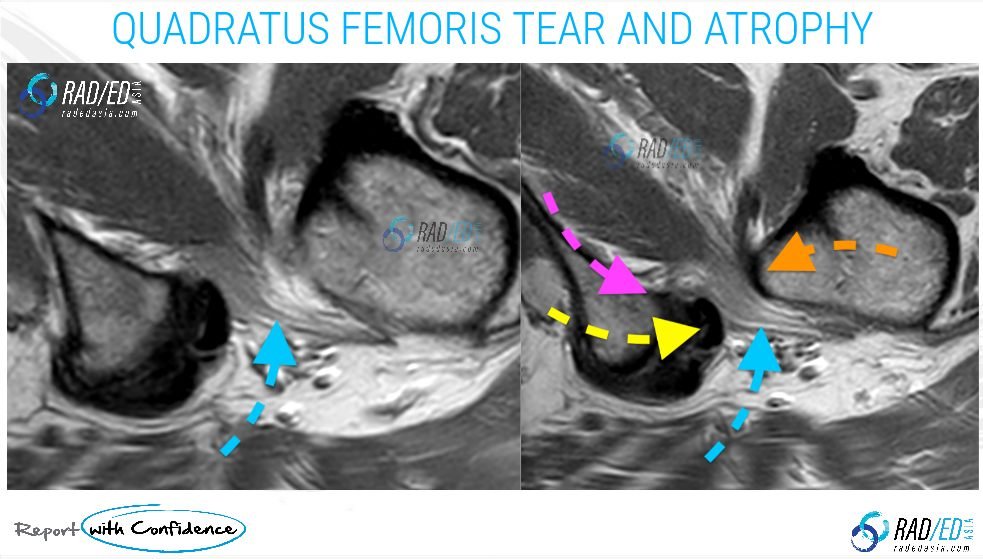 ISCHIOFEMORAL IMPINGEMENT MRI A PAIN IN THE BUTT Radedasia ISCHIOFEMORAL IMPINGEMENT MRI A PAIN IN THE BUTT Radedasia